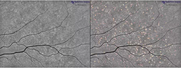 Aen Tester konnten onheelbar Alzheimer Krankheet Joerzéngte virum Ufank erkennen 50916_1